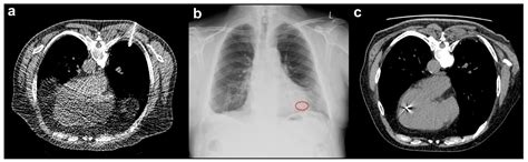 Cancers Free Full Text Risks And Benefits Of Fiducial Marker