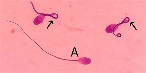 Spermatozoa After Hypoosmotic Swelling Test Arrow Hypoosmotic