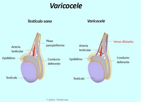 Varicocele Testicular Que Es Grado Operacion Infertilidad Causas
