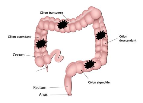 Cancer Du Colon Pôle Digestif Lyon Est