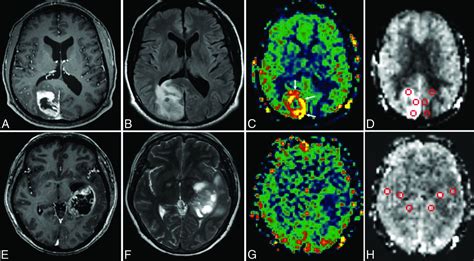 Arterial Spin Labeling Perfusion Mri Stratifies Progression Free
