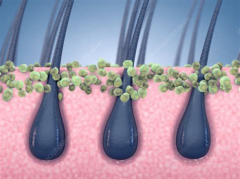 Fungal Infection Of The Scalp Illustration Stock Image F031 0856