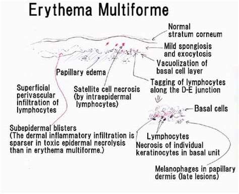 Erythema Multiforme Differential
