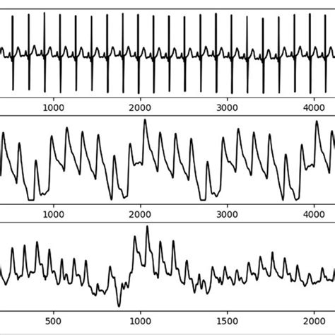 the ecg signal a shows a strong qrs complex together