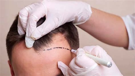Unshaven Hair Transplant Experience The Best Hair Transplant In Turkey