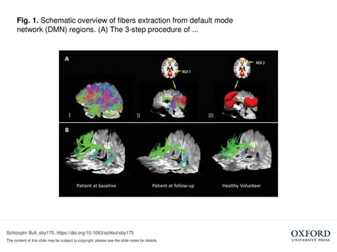 Fig 2 Default Mode Network Dmn Patterns In Each Of The 3 Groups And