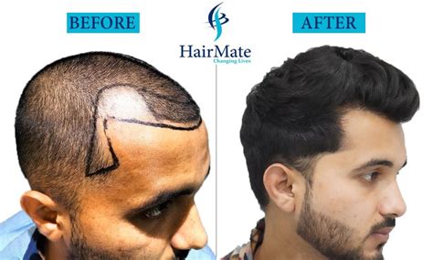 Hair Transplant In Delhi Hairmate Clinic Delhi Best Hair