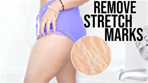 How To Get Rid Of Stretch Marks Fast And Naturally Diy Home Remedies
