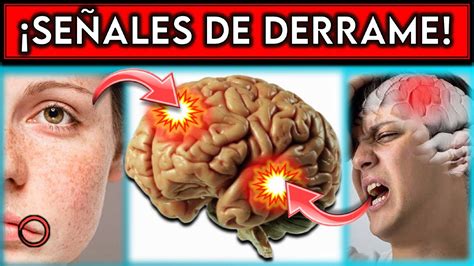 ¡estas SeÑales Te Avisan De Un Derrame Cerebral ¡no Las Ignores