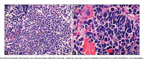 Figure 1 From A Rare Case Of Extraskeletal Ewings Sarcoma Primitive