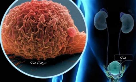آیا سرطان مثانه کشنده است یا قابل درمان؟ دکتر ناطق جراح کلیه