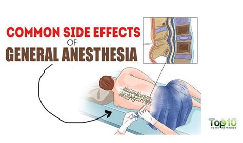 Side Effects Of General Anesthesia You Must Know Top 10 Home Remedies