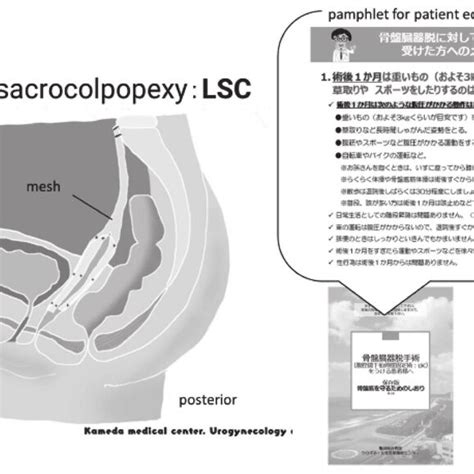 Laparoscopic Sacrocolpopexy （lsc） And Leaflet For After Surgery
