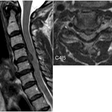 Reconstructed Currents Of The Cervical Spondylotic Myelopathy Patient