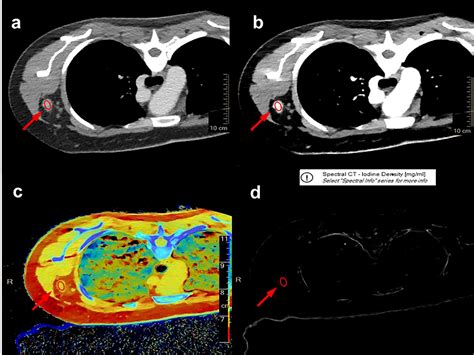 Figure 3 From Detection Of Axillary Lymph Node Metastasis In Breast
