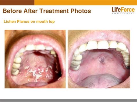 Oral Lichen Planus Photos Before And After Treatment Pictures Of Mou…