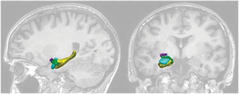 Three Dimensional Relationship Of The Right Piriform Cortex On The
