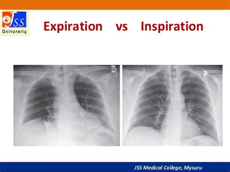 Approach To Chest X Ray And Interpretation