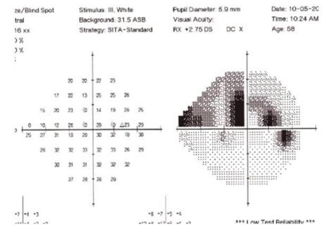 Visual Field Test Glaucoma