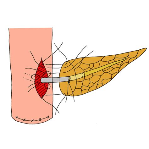Purse String Suturing Technique The Pancreatic Anastomosis
