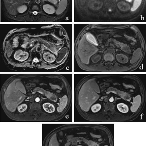 A 57 Year Old Man Had Pdac A T2wi The Round Pancreatic Head Mass