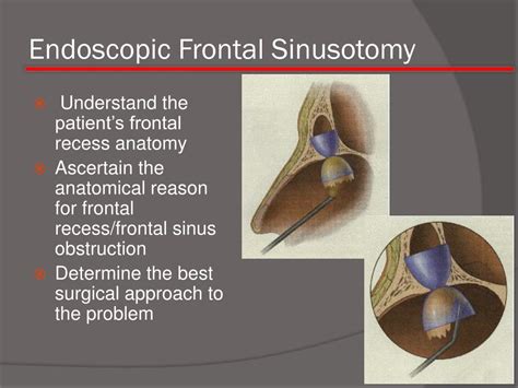 Ppt Frontal Sinus Surgery Powerpoint Presentation Free Download Id
