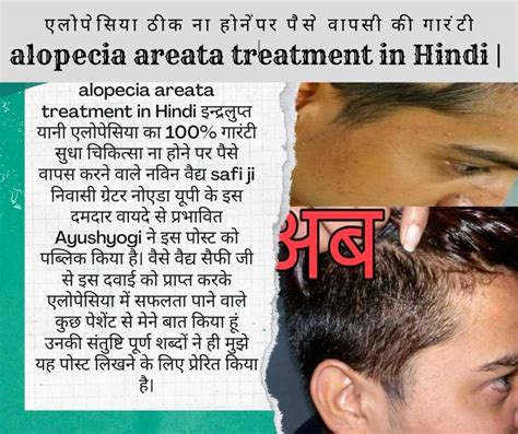 Alopecia Areata Treatment Hindi इंद्रलुप्त आयुर्वेदिक 100 चिकित्सा