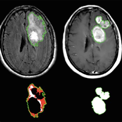 Example Of Automated Glioma Segmentation Using Deep Learning Showing