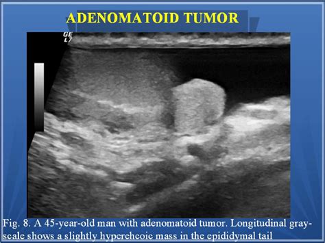 Figure 8 From Sonographic Findings Of Epididymal Masses Semantic Scholar