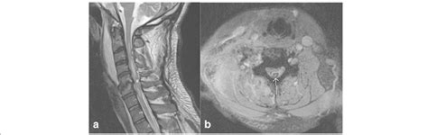 Sagittal T2 Weighted Image A And Axial Gradient Recalled Echo Gre