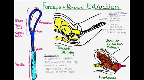 Forceps Vs Vacuum Extraction Delivery Ventouse Understanding The