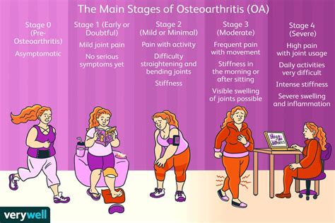 the stages of osteoarthritis