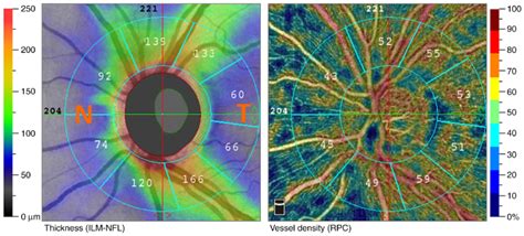 Optical Coherence Tomography Angiography Report Retinal Nerve Fiber