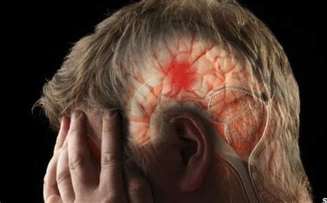 Señales Las Cuales Indican Que Puedes Sufrir Un Derrame Cerebral