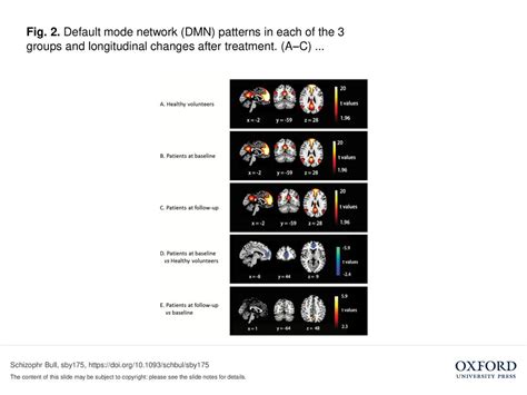 Fig 2 Default Mode Network Dmn Patterns In Each Of The 3 Groups And