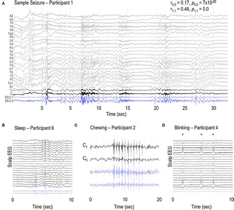 Frontiers Seizure Forecasting Using A Novel Sub Scalp Ultra Long Term