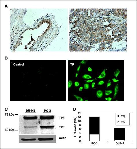 Thromboxane A2 Receptors In Prostate Carcinoma Expression And Its Role