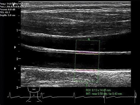 Carotid Intima Media Thickness And The Prediction Of Vascular Events