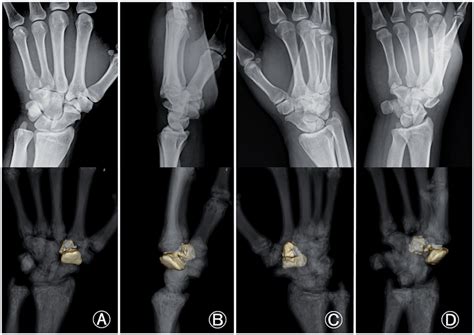Comparison Between X Ray And Three Dimensional Computed Tomography 3 D