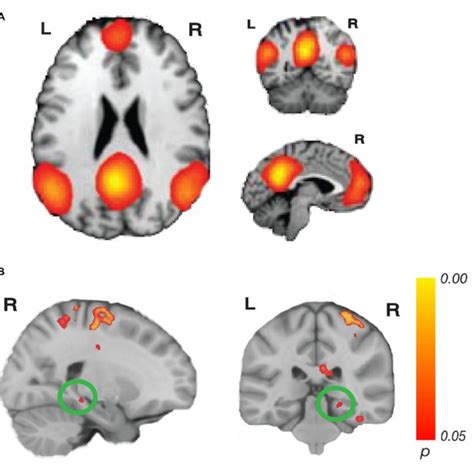Network Connectivity Results Of The Default Mode Network Dmn A