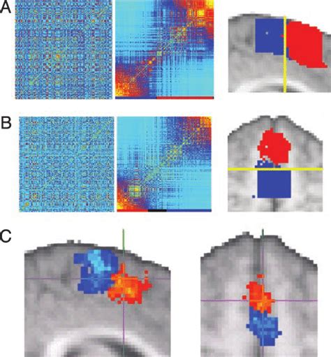 Connectivity Based Parcellation Of Medial Frontal Cortex A And B