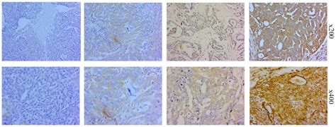 Myh9 Overexpression Correlates With Clinicopathological Parameters And