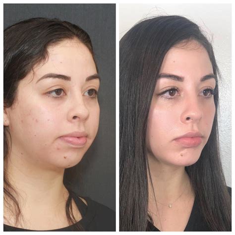 Buccal Fat Removal Before And After Patient 01 Nayak Plastic Surgery