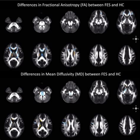Regions Demonstrating Differences In A Fractional Anisotropy Fa And