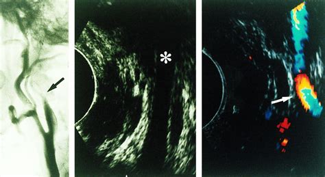 transoral carotid ultrasonography stroke