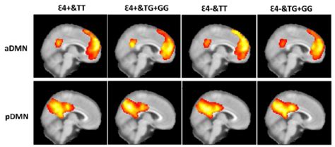 Default Mode Network Dmn Two Components Were Identified Anterior