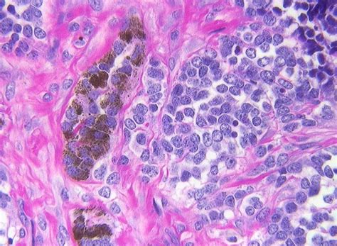 Figure 4 From Management Of Melanotic Neuroectodermal Tumor Of Infancy