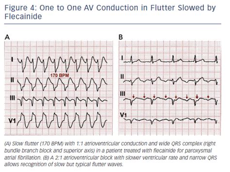 atrial flutter typical and atypical