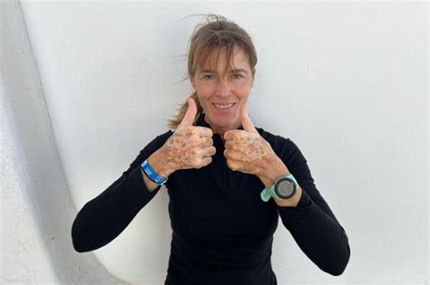 Lanimatrice Nathalie Simon Affiche Son Vitiligo Et Soutient Les