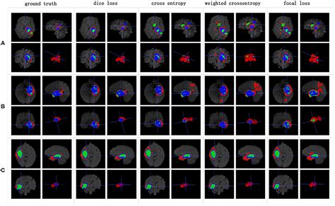 Frontiers Nested Dilation Networks For Brain Tumor Segmentation Based